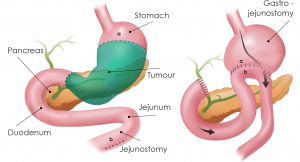 Gastric & oesophageal cancer Surgery - Digestive Cancers Europe