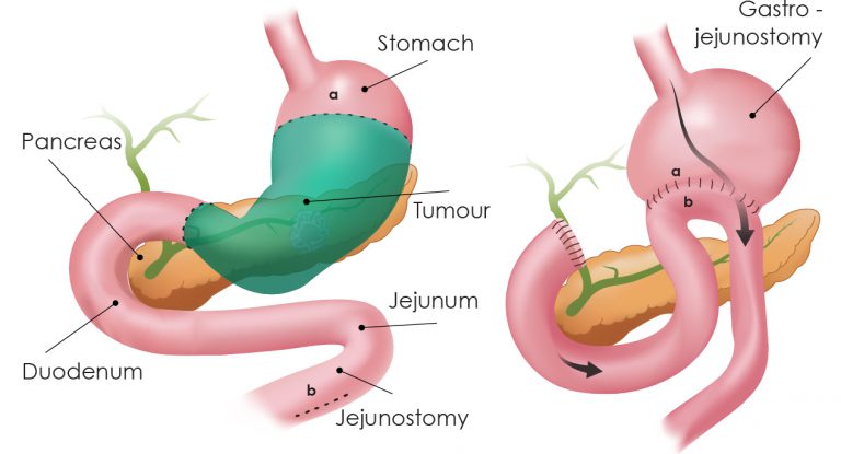 Gastric & oesophageal cancer Surgery - Digestive Cancers Europe