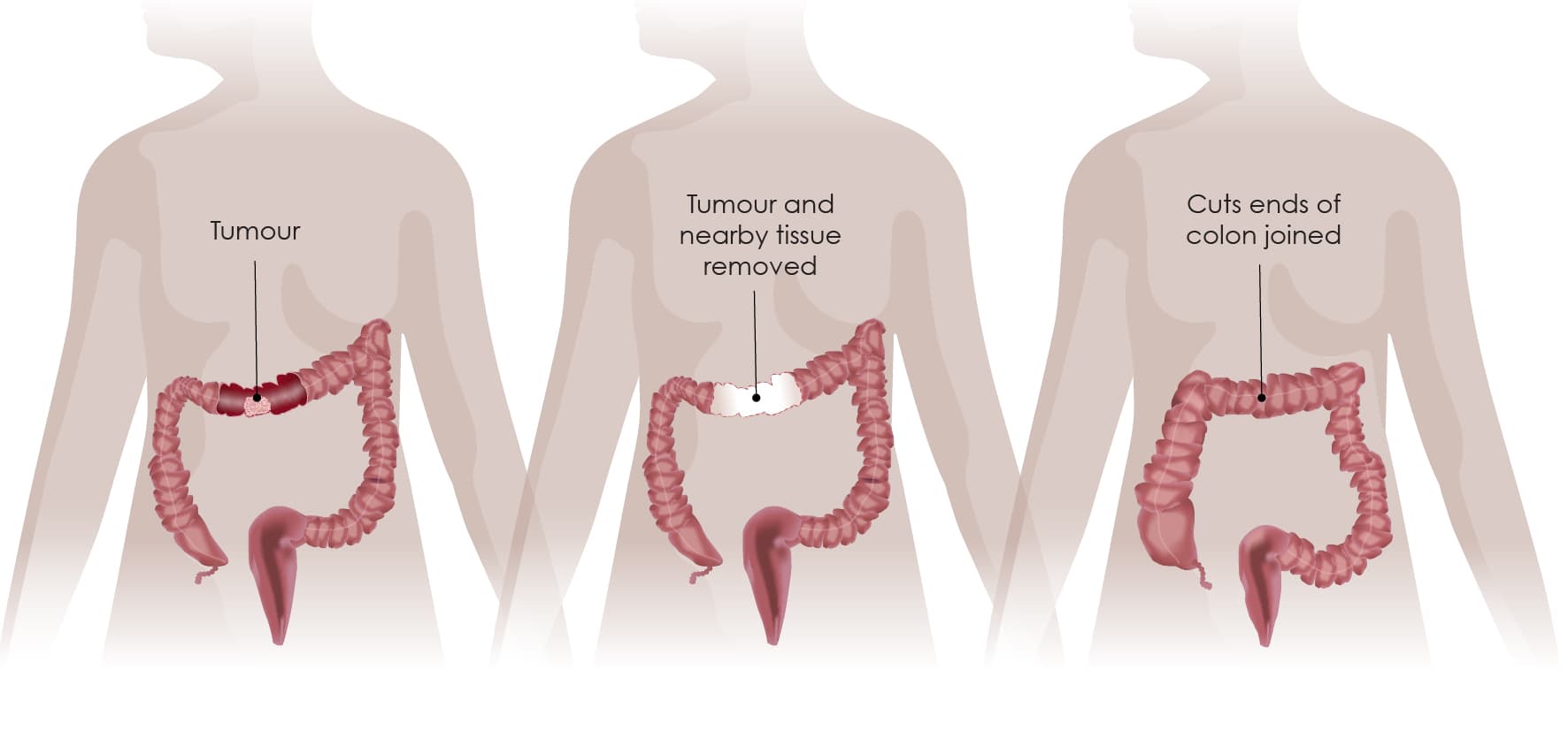 Bladder Problems After Colon Resection At Makayla Moffatt Blog Bladder Problems After Colon Resection At Makayla Moffatt Blog